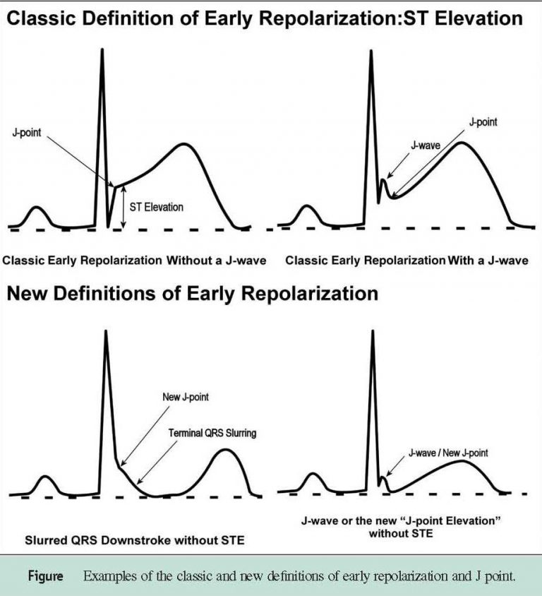 Cardiovascular Adaptations to Exercise and the Athlete EKG • truPhys